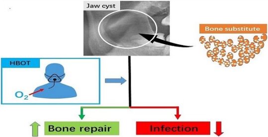 Role of Hyperbaric Oxygen Therapy (HBOT) in Osteomyelitis